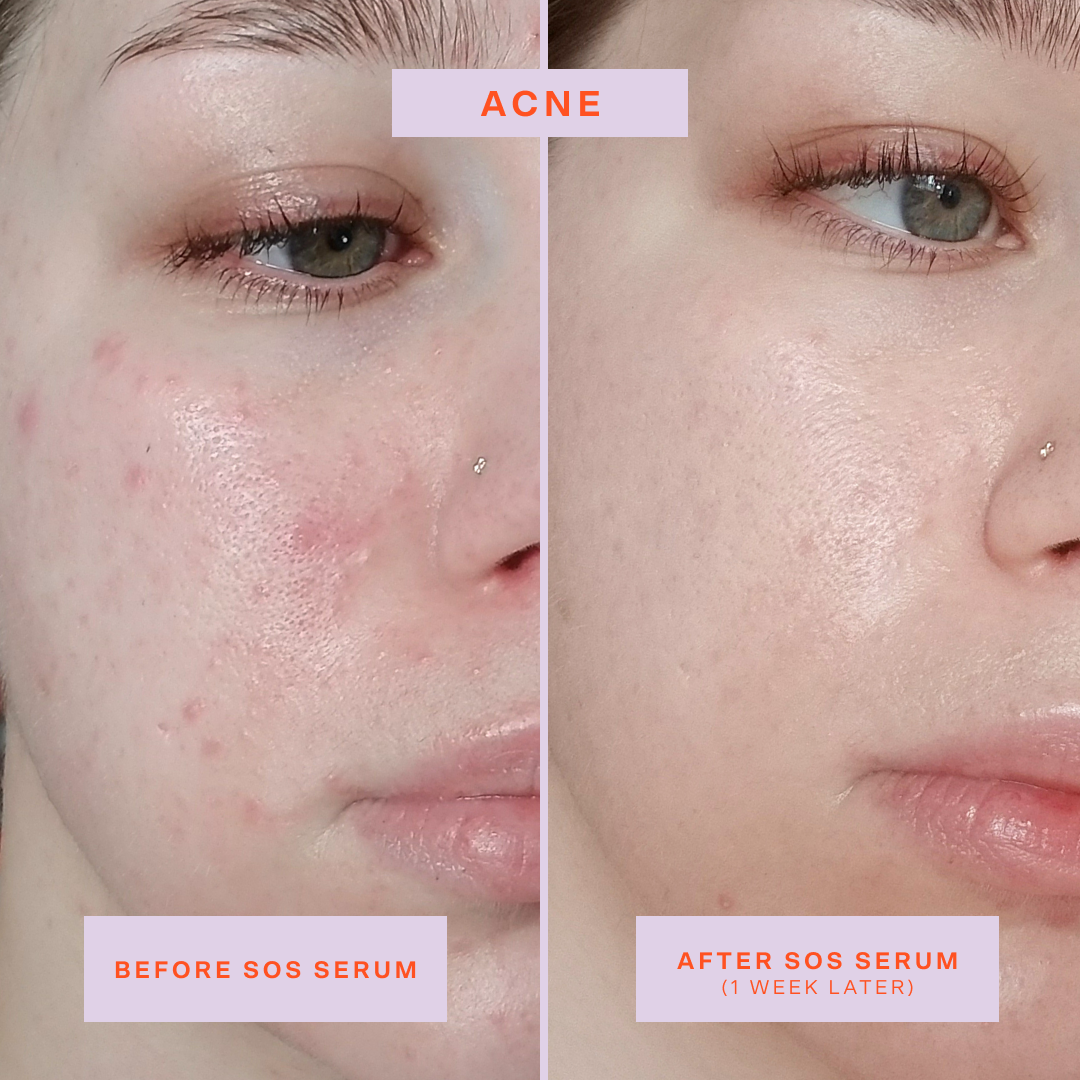 SOS Intensive Rescue Serum with Hypochlorous Acid | Tower 28 Beauty
